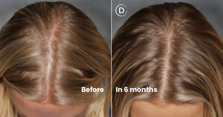 Hair loss Before & After Photos | Dermatology Circle - DR. VIKTORYIA ...