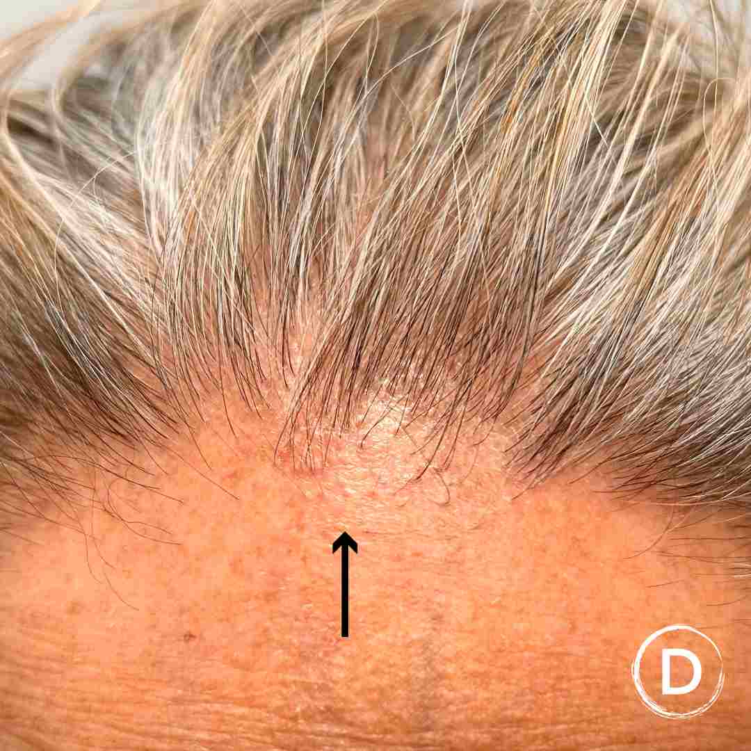 Lichen Planopilaris - NYC | Frontal Fibrosing Alopecia Treatment in New ...