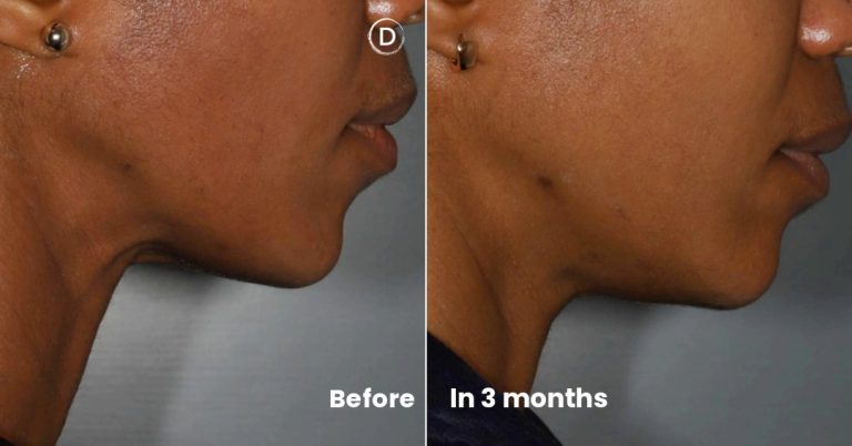 Before and after - DERMATOLOGY CIRCLE