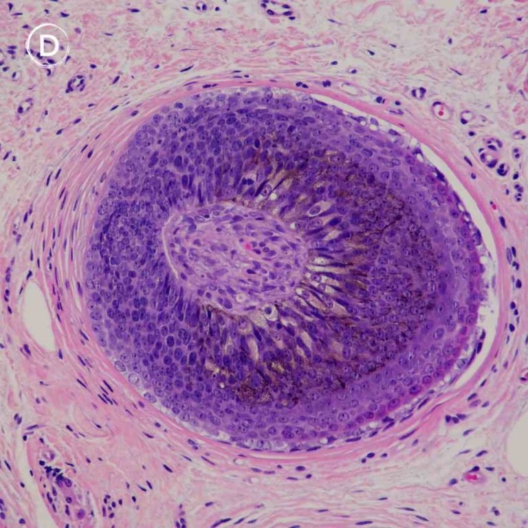 Understanding Scalp Biopsies - Dermatology Circle NYC