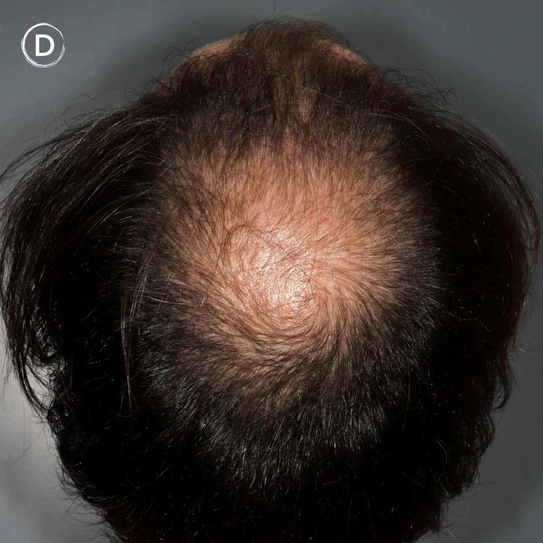 Alopecia androgenetica and demntia in women in NYC - New York